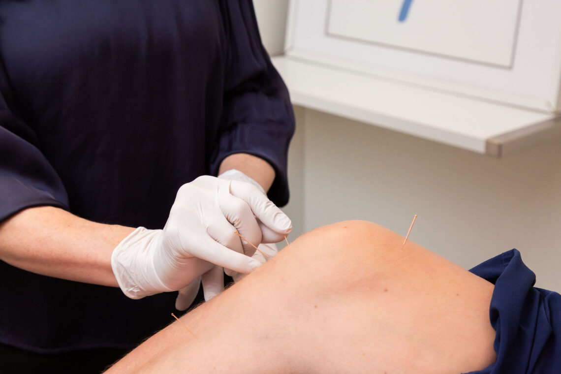 Acupuncture Vancouver, BC - Balance Physio